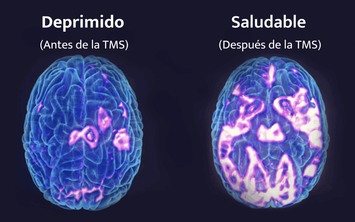 Terapia TMS - My TMS